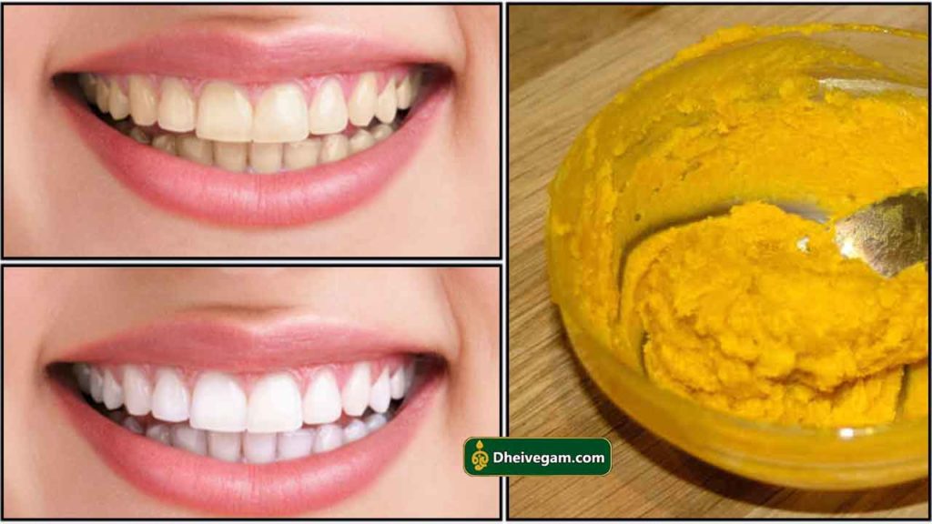 மஞ்சள் கறை பல் | Teeth Problems Home Remedies in Tamil