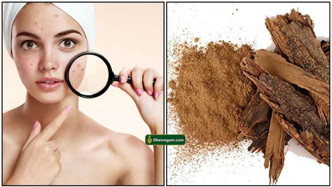 முகப்பரு நீங்க என்ன செய்ய வேண்டும் | Mugaparu maraya tips in Tamil