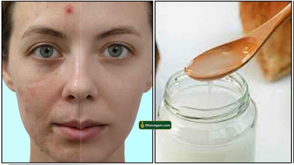 முகப்பரு தழும்புகளைப் போக்க இயற்கை வழிகள் | Mugaparu thalumbu maraiya tips