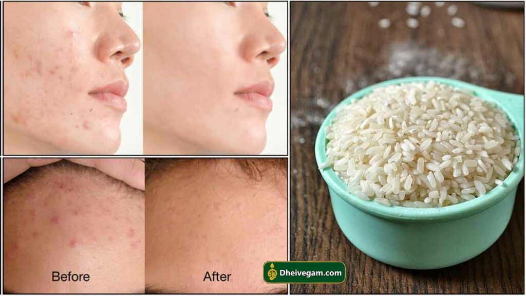 முகப்பருவுக்கு மேல ஒரு சொட்டு இதை மட்டும் தடவுங்க. மூன்றே நாட்களில் ...